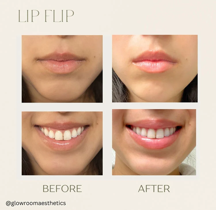 Lip Flip Before and After: 14+ Real Results You Need to See