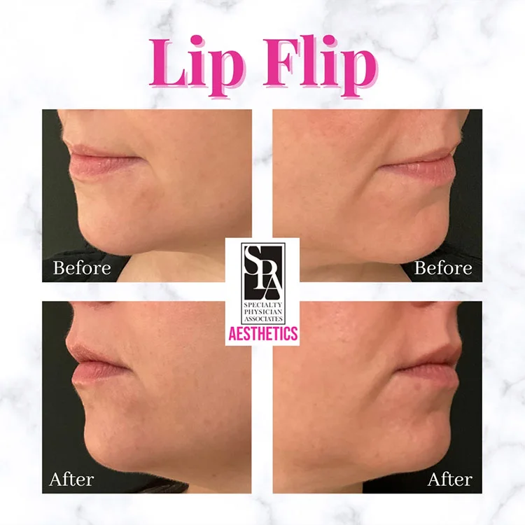 Lip Flip Before and After: 14+ Real Results You Need to See