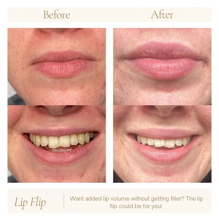 Lip Flip Before and After: 14+ Real Results You Need to See