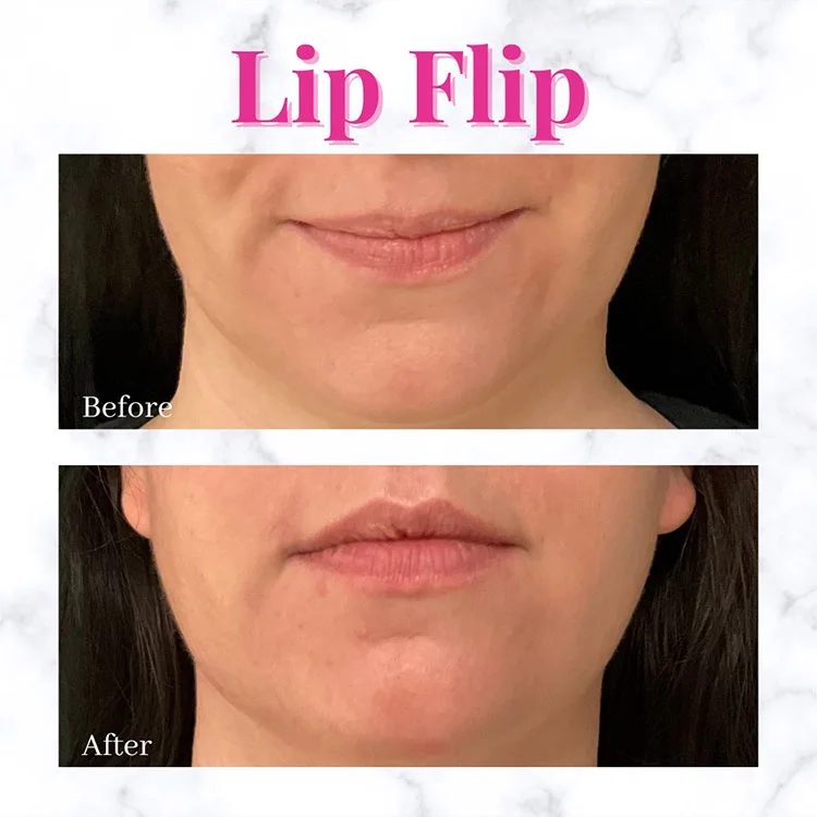 Lip Flip Before and After: 14+ Real Results You Need to See