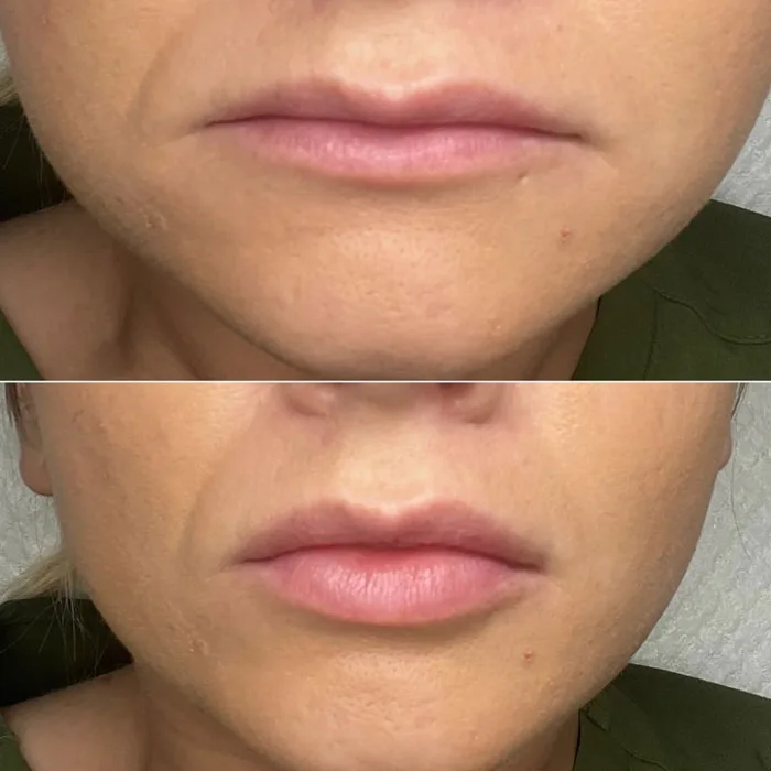 Lip Flip Before and After: 14+ Real Results You Need to See